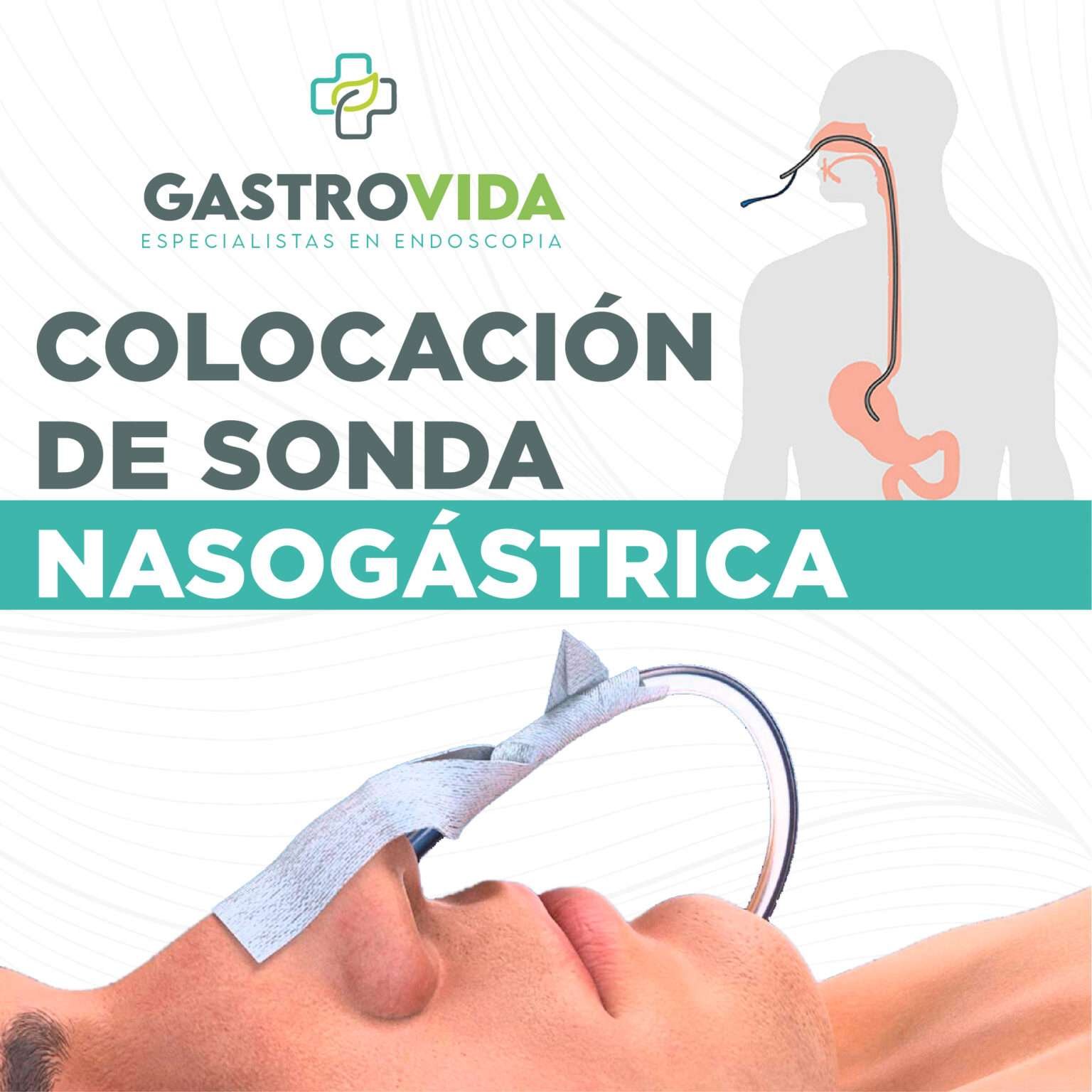 Colocación de Sonda Nasogástrica: Procedimiento y Cuidados